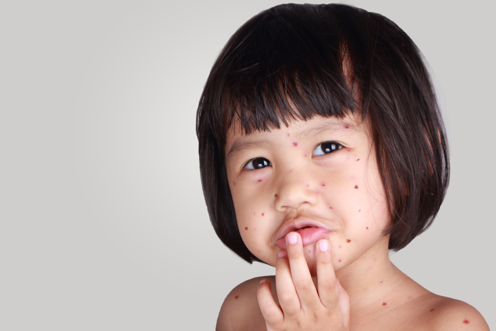 Parenting 101- Can chickenpox be prevented?